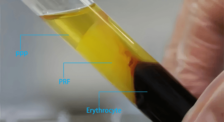 Platelet-Rich Fibrin (PRF) – Revolutionary Blood-Derived Therapy